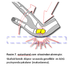 Skafoid Kırığı | Prof. Dr. Hakan Gündeş | El Cerrahisi Uzmanı