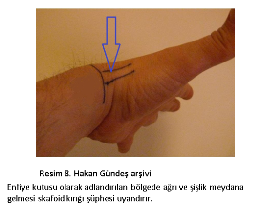 Skafoid Kırığı | Prof. Dr. Hakan Gündeş | El Cerrahisi Uzmanı